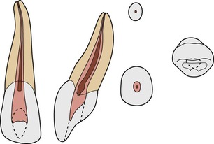 Pulp space anatomy and access cavities
