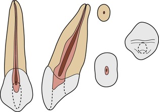 Pulp space anatomy and access cavities