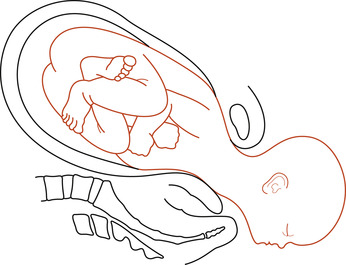 Cephalopelvic disproportion, obstructed labour and other obstetric ...