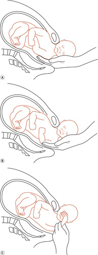 Cephalopelvic disproportion, obstructed labour and other obstetric ...