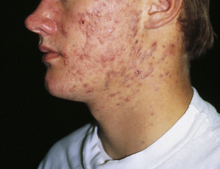 Pathophysiology: The Biologic Basis for Disease in Adults and Children