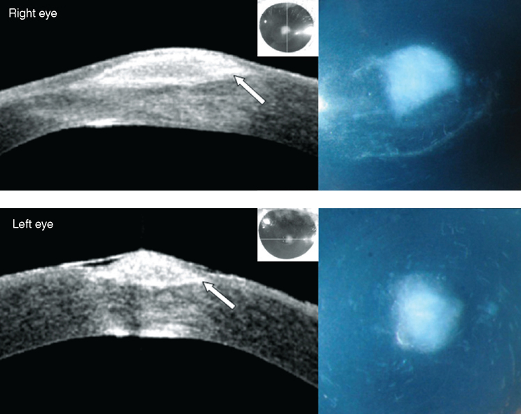 Spectral-domain Optical Coherence Tomography Imaging of the Eye