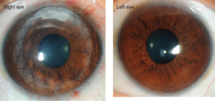 Spectral-domain Optical Coherence Tomography Imaging of the Eye
