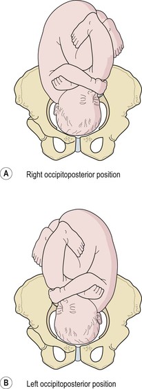 Malpositions of the occiput and malpresentations