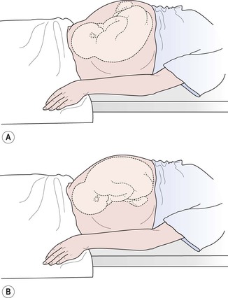 Malpositions of the occiput and malpresentations