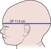 Malpositions of the occiput and malpresentations