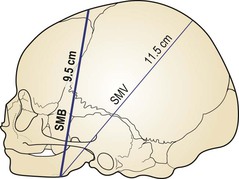 Malpositions of the occiput and malpresentations