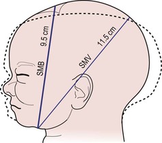Malpositions of the occiput and malpresentations