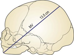 Malpositions of the occiput and malpresentations