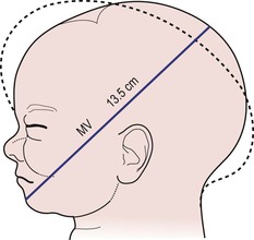 Malpositions of the occiput and malpresentations