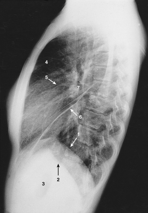 Chest X-Ray Made Easy