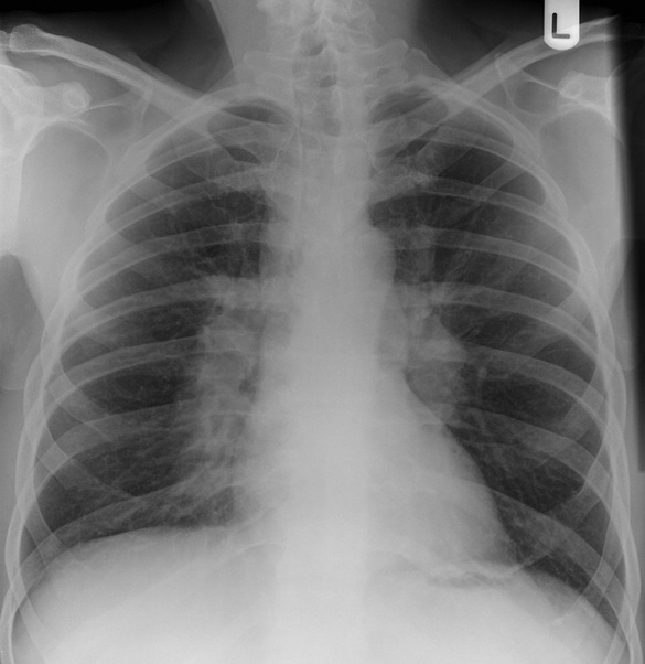 Chest X-Ray Made Easy