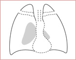 Chest X-Ray Made Easy
