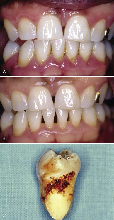 Periodontology for the Dental Hygienist