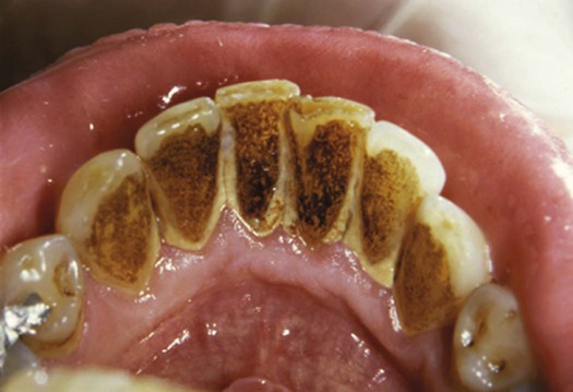 Periodontology for the Dental Hygienist