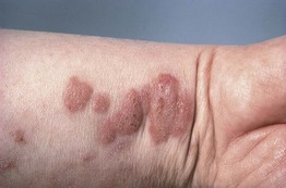 Eosinophilic Dermatoses