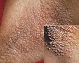 Disorders of Eccrine and Apocrine Glands