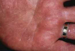 Disorders of Eccrine and Apocrine Glands