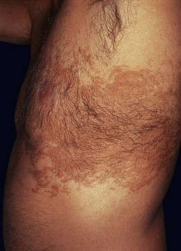 Hypertrichosis and Hirsutism