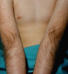 Hypertrichosis and Hirsutism