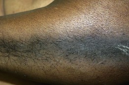 Hypertrichosis and Hirsutism