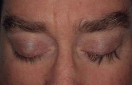 Hypertrichosis and Hirsutism