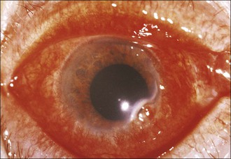 The eye in rheumatic disease