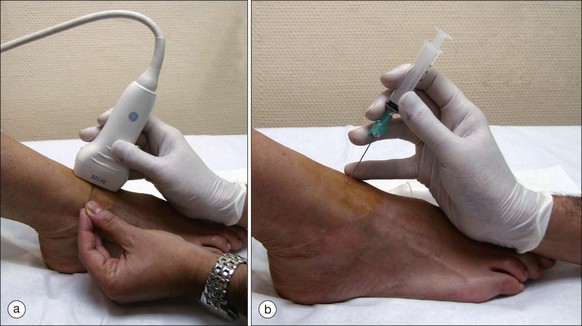 Aspiration and injection of joints and periarticular tissue and ...