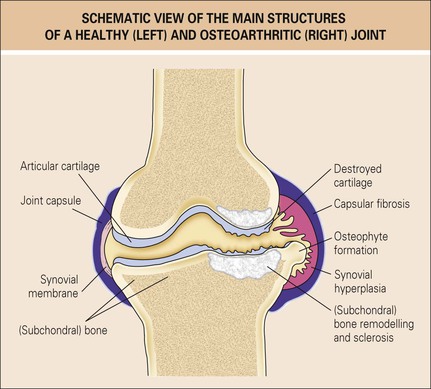 Pathogenesis and pathology of osteoarthritis