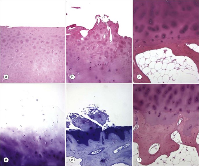 Pathogenesis and pathology of osteoarthritis