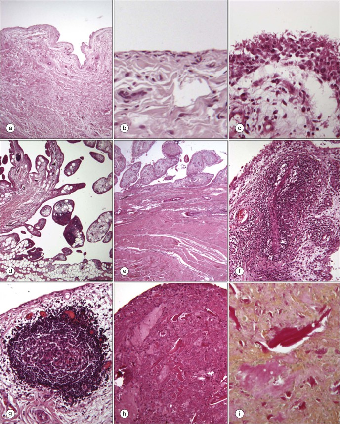 Pathogenesis and pathology of osteoarthritis