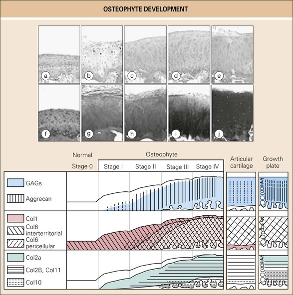 Pathogenesis and pathology of osteoarthritis