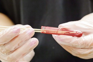 Evaluating the Blood Film