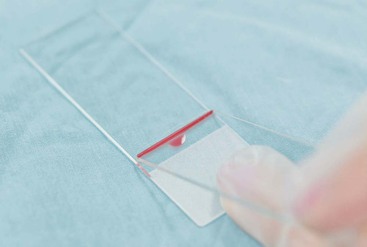 Evaluating the Blood Film