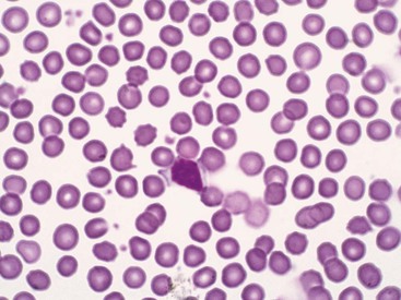 Evaluating the Blood Film