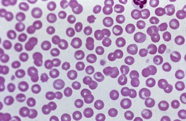 Evaluating the Blood Film