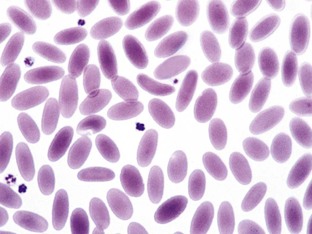 Evaluating the Blood Film