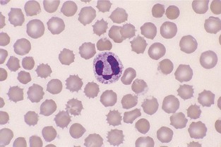 Morphologic Abnormalities of Blood Cells