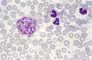 Morphologic Abnormalities of Blood Cells