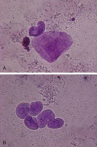 Urine Sediment Analysis