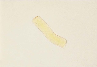 Urine Sediment Analysis