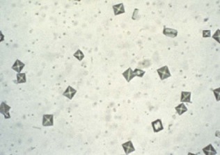 Urine Sediment Analysis