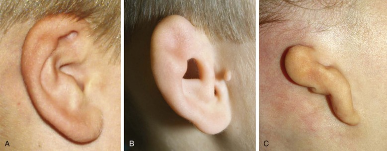 Cummings Pediatric Otolaryngology