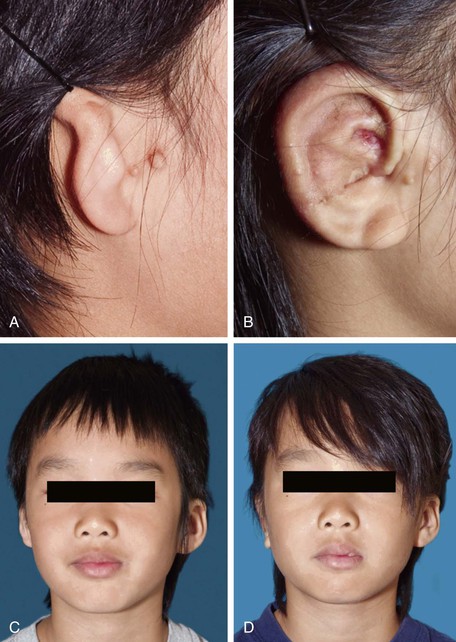 Cummings Pediatric Otolaryngology