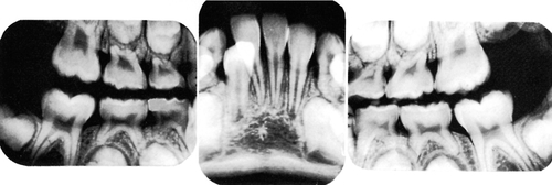 Wheeler’S Dental Anatomy, Physiology, and Occlusion