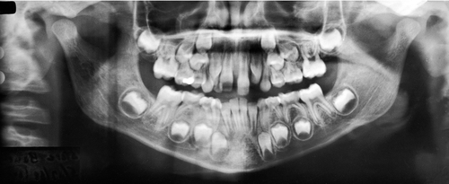 Wheeler’S Dental Anatomy, Physiology, and Occlusion