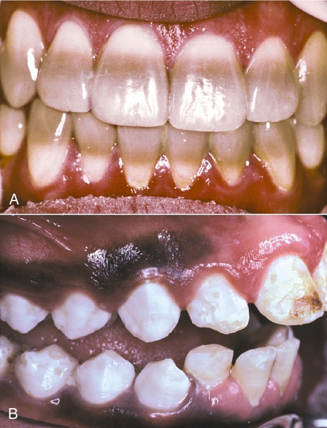 Wheeler’S Dental Anatomy, Physiology, and Occlusion