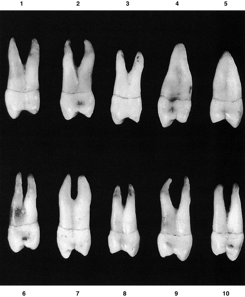 Wheeler’S Dental Anatomy, Physiology, and Occlusion