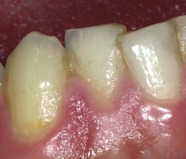 Carranza's Clinical Periodontology