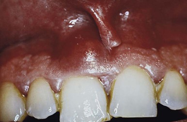 Carranza's Clinical Periodontology